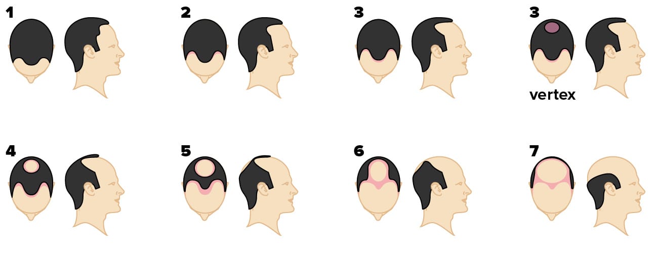 The Norwood Scale: The 7 Stages Of Male Pattern Baldness